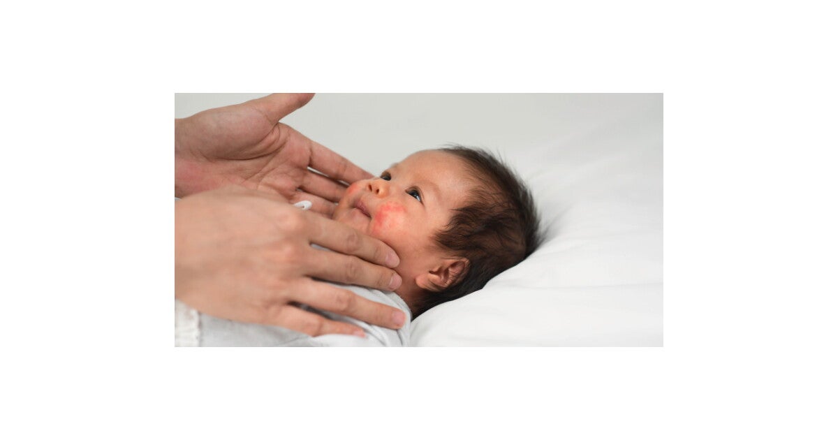 Penyebab dan Cara Mencegah Kulit Bayi Merah